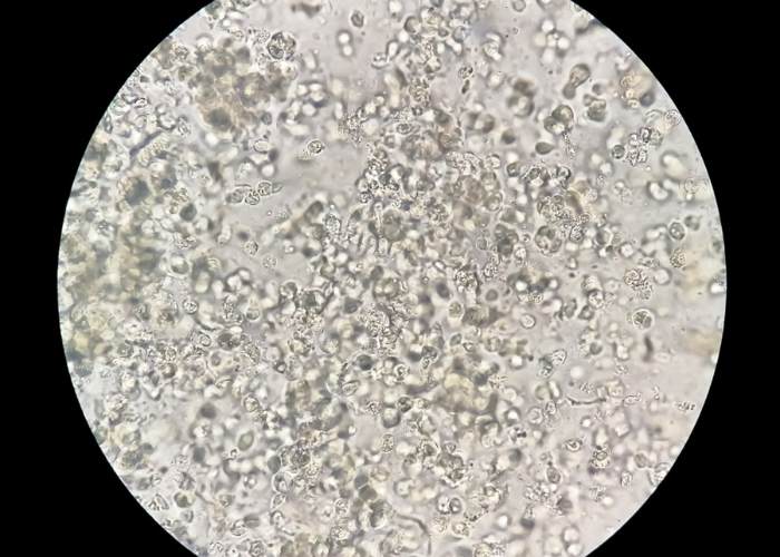 Πυοσφαίρια Ούρων | Αυξημένες τιμές & αντιμετώπιση